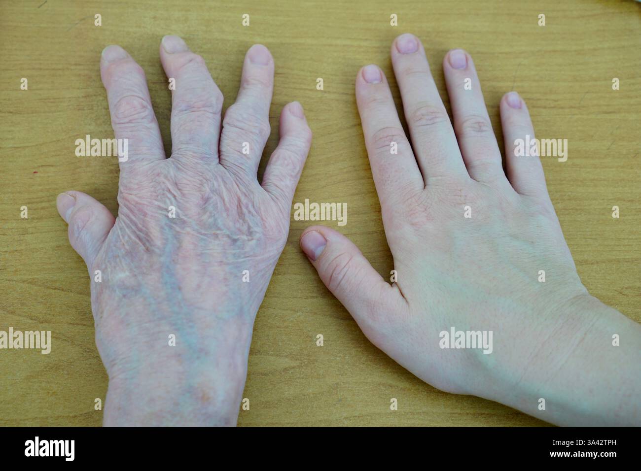 Close-up comparison of a healthy hand and an arthritic hand placed side ...