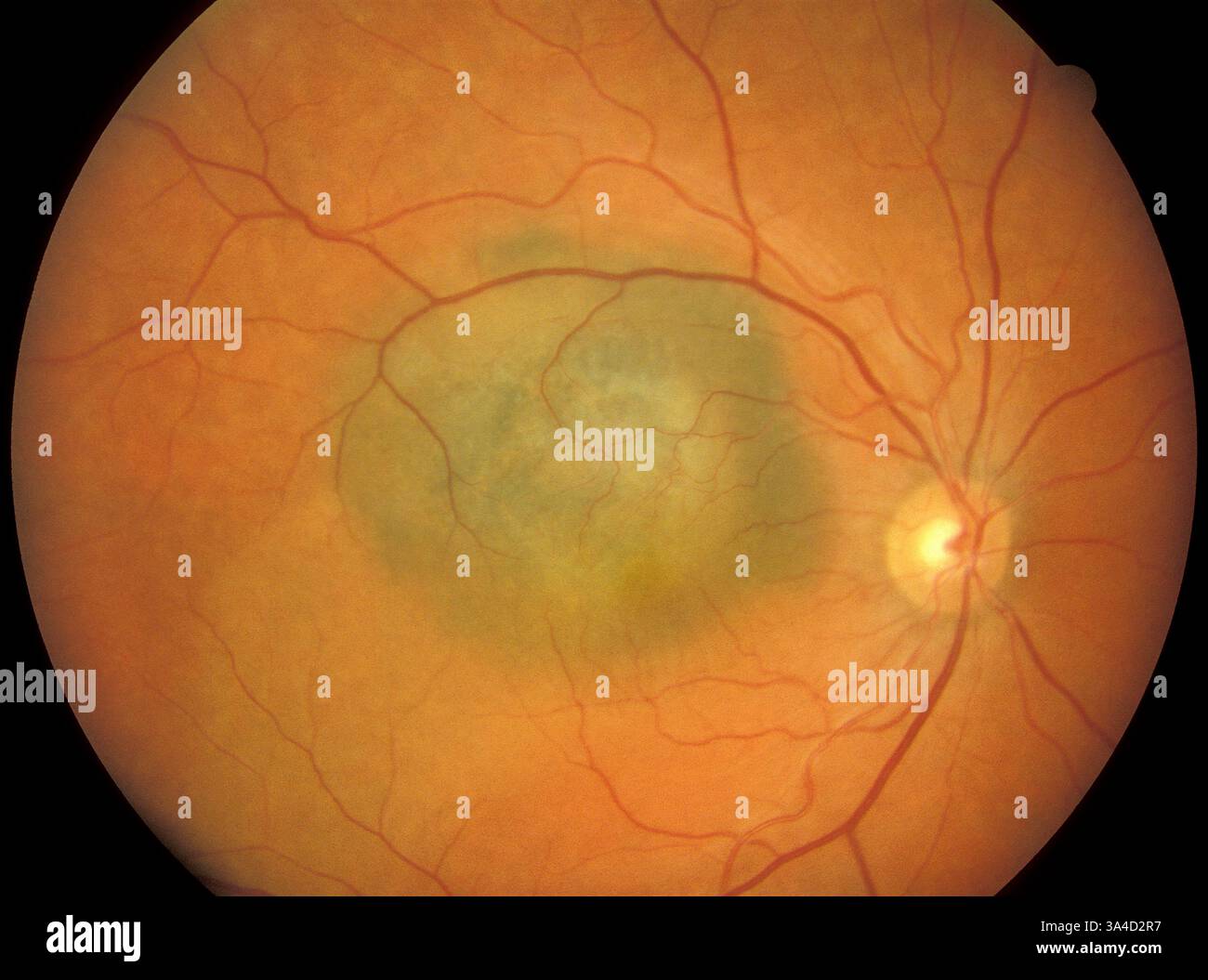 Eye cancer. View of the right optic fundus of the eye of a patient with ...