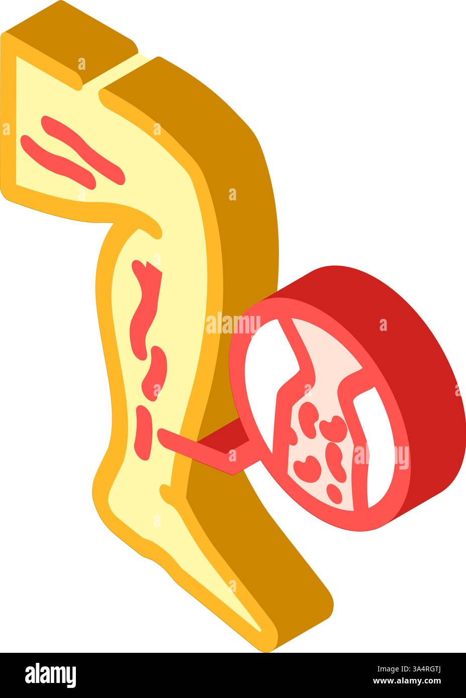 deep vein thrombosis cardiology disease isometric icon vector ...