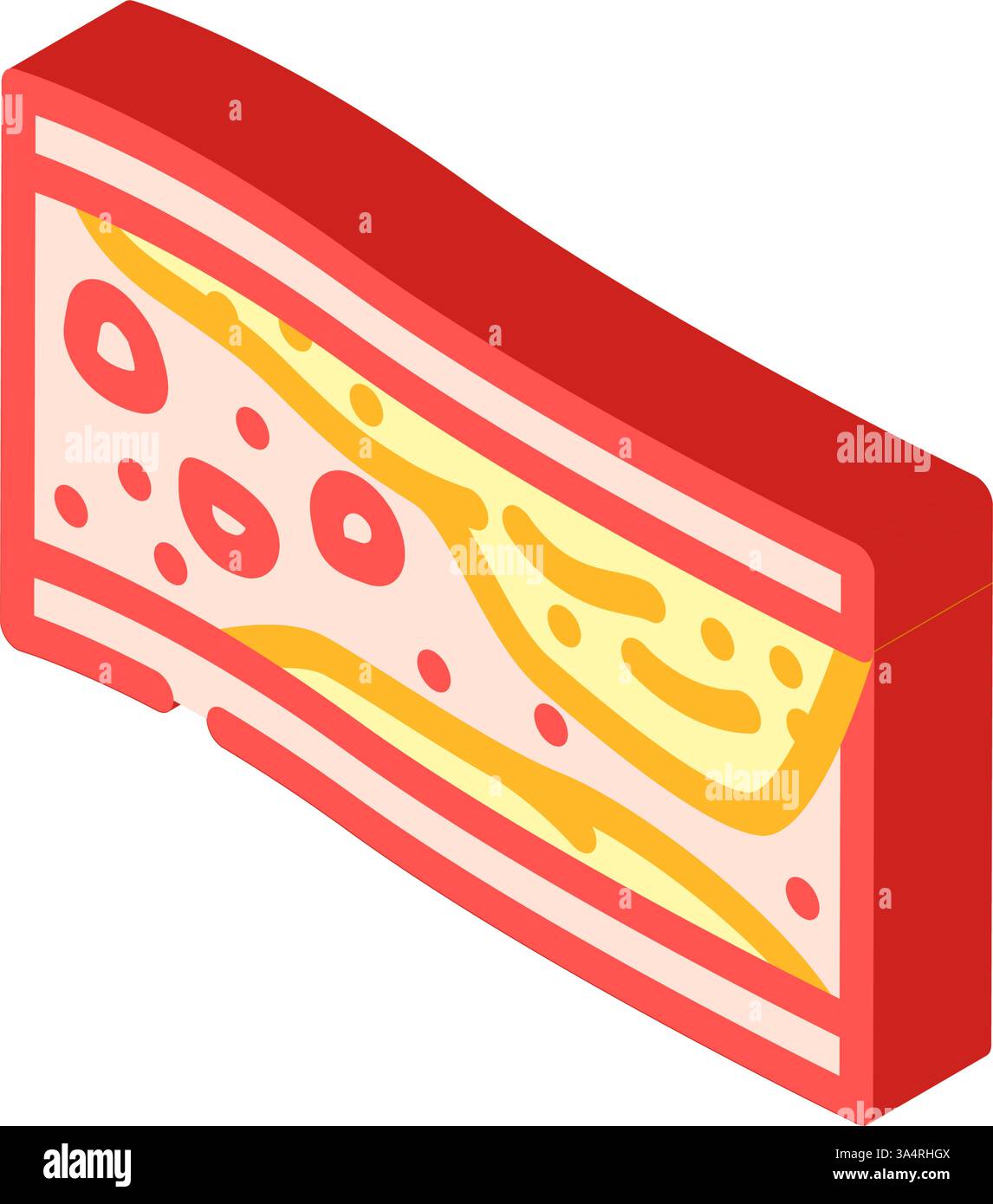 atherosclerosis cardiology disease isometric icon vector illustration ...