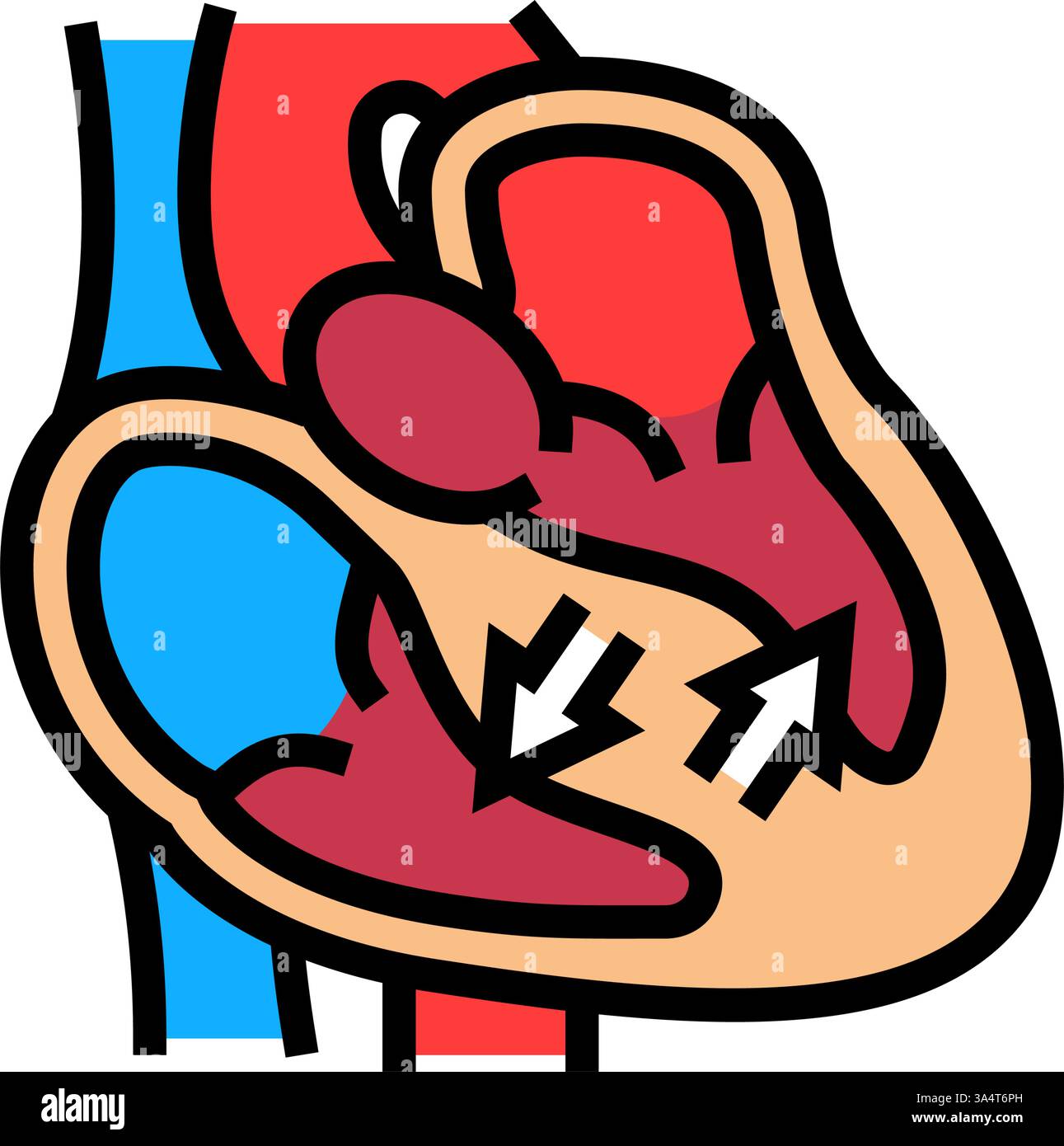 hypertrophic cardiomyopathy cardiology color icon vector illustration ...