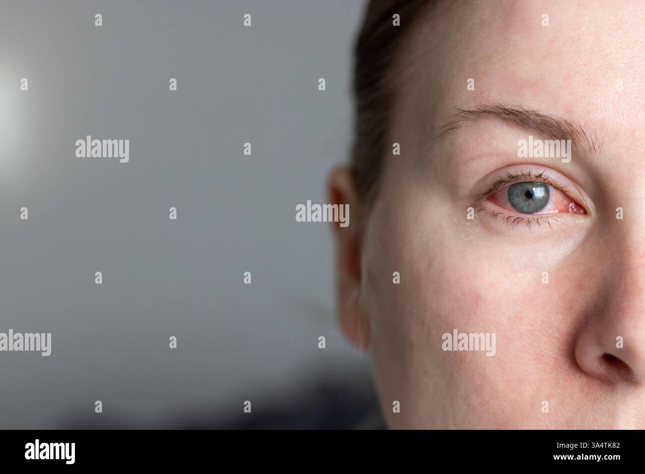 Close up of female face with one red eye suffering from infection ...