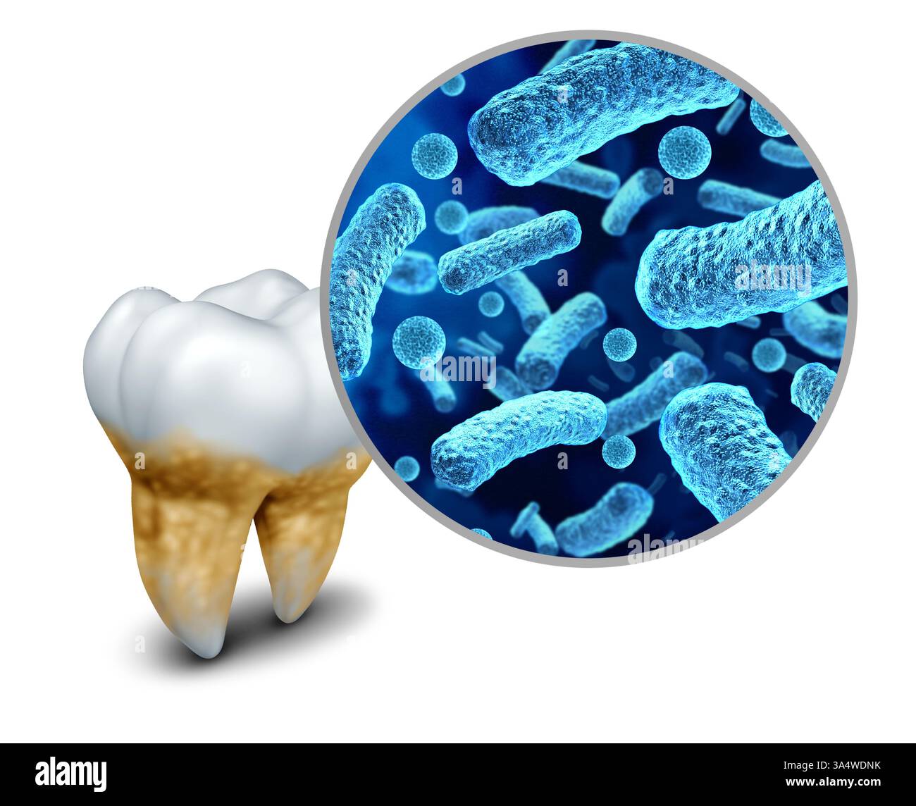 Dental Plaque Bacteria as a tooth infection and teeth decay disease ...