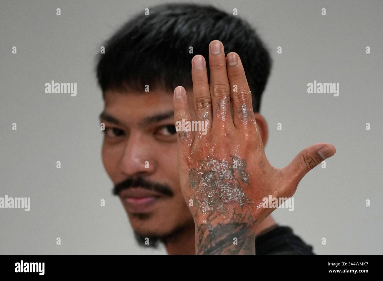 A Muslim displays his hand after having tattoos on his fingers removed ...