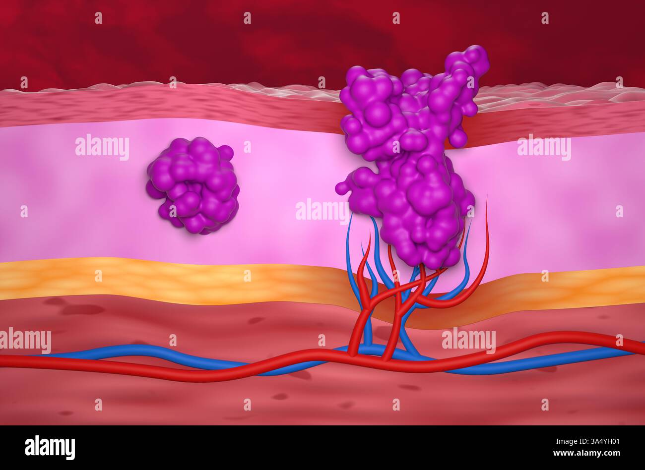 Benign vs. malignant tumors - isometric view 3d illustration Stock ... Benign vs. malignant tumors - isometric view 3d illustration Stock ...
