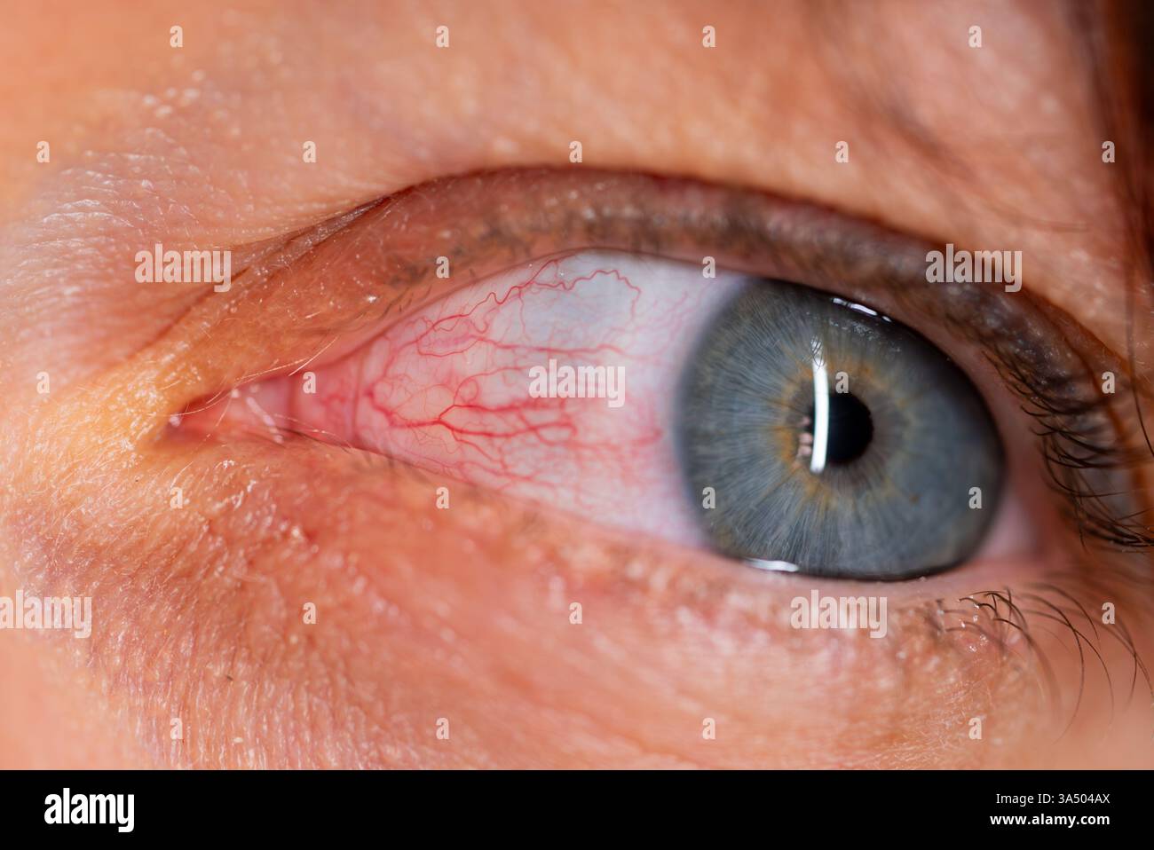 Red eye displaying burst blood vessels from subconjunctival hemorrhage ...