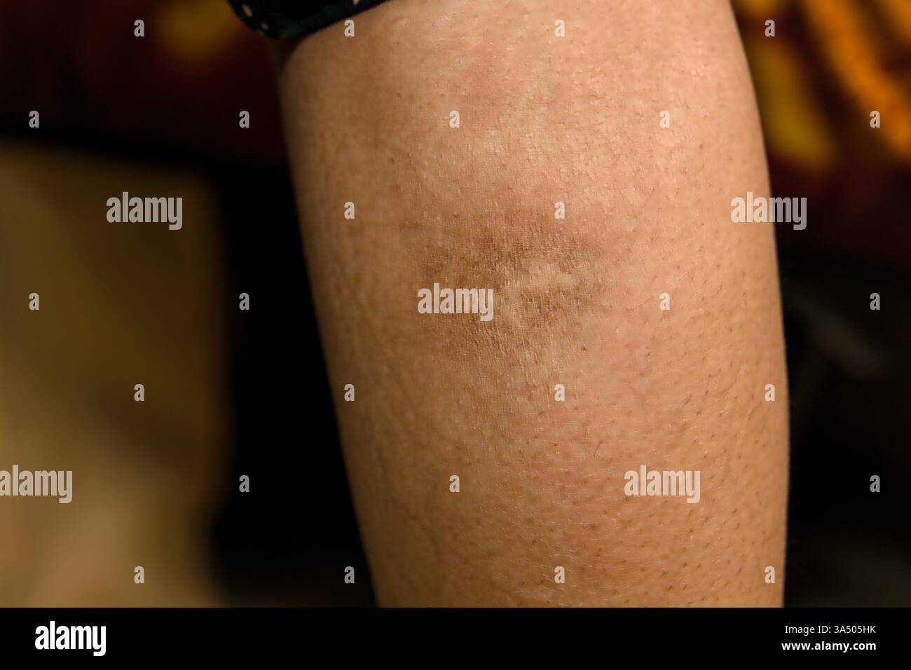 Close-up of a healing bruise on a person's knee, showcasing skin ...