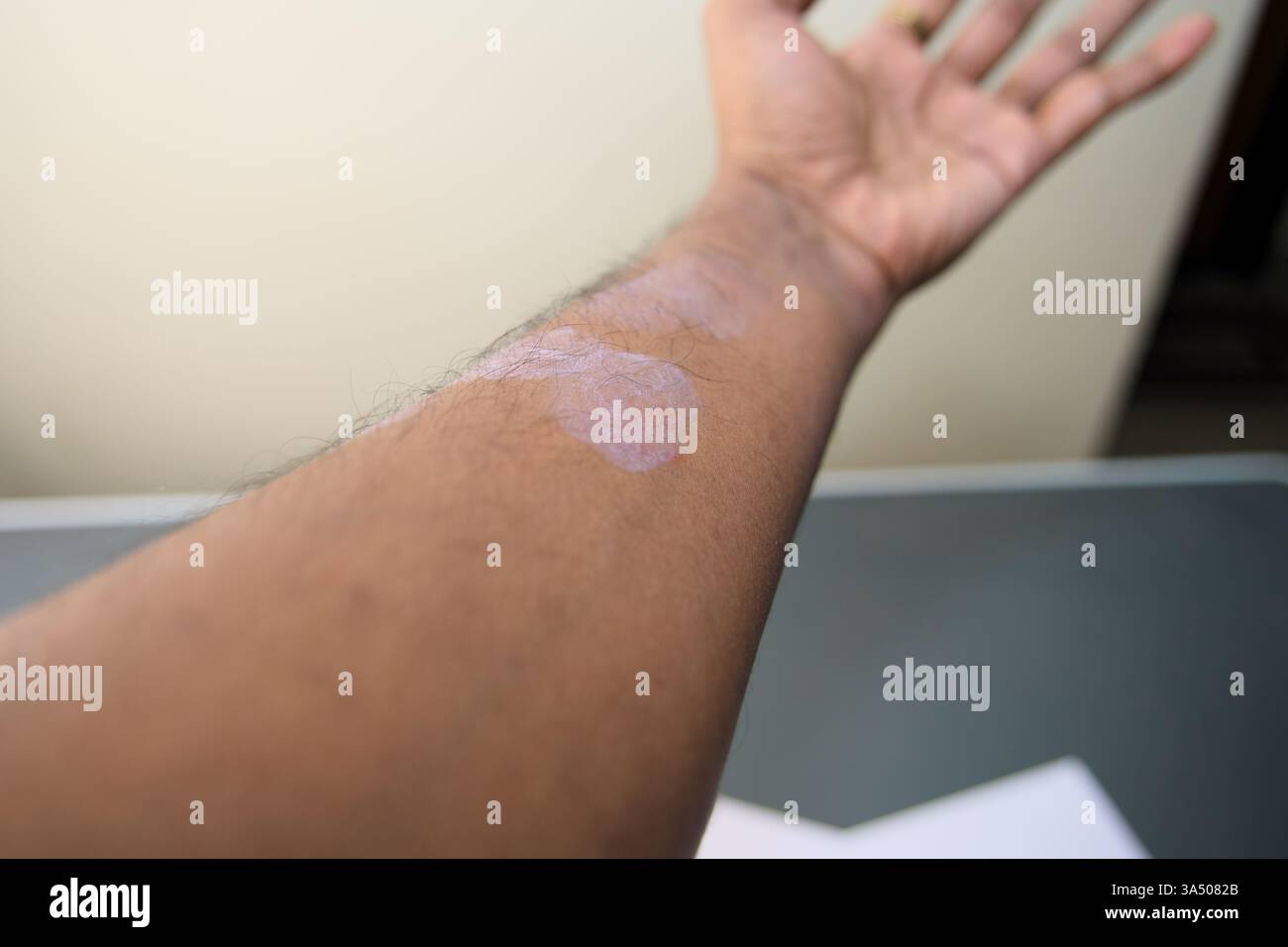 Scars arm hi-res stock photography and images - Alamy