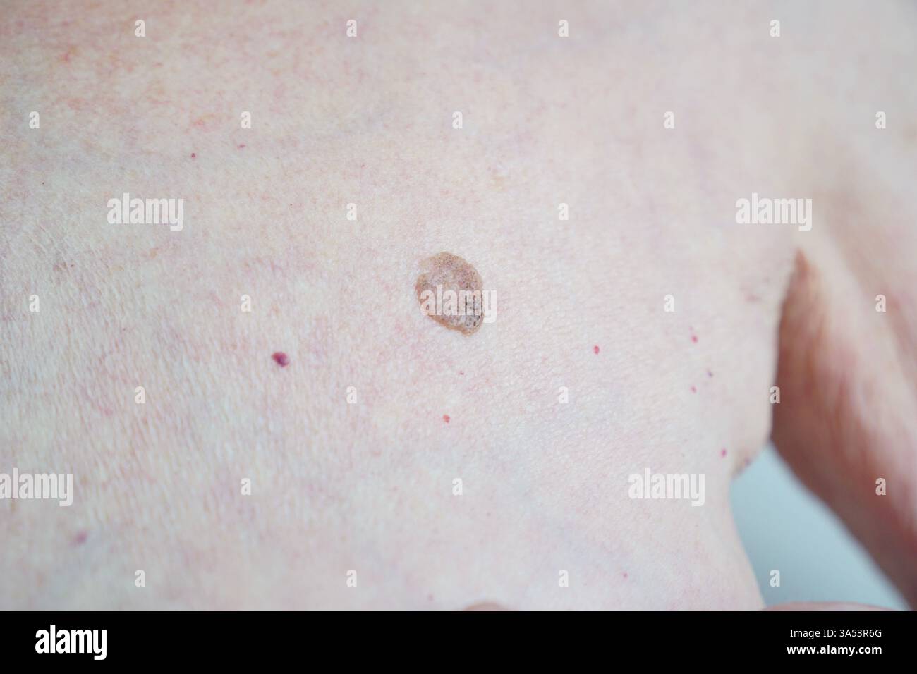 Moles and Skin Cancer Hidden Dangers on Aged Womens Skin. High quality ...