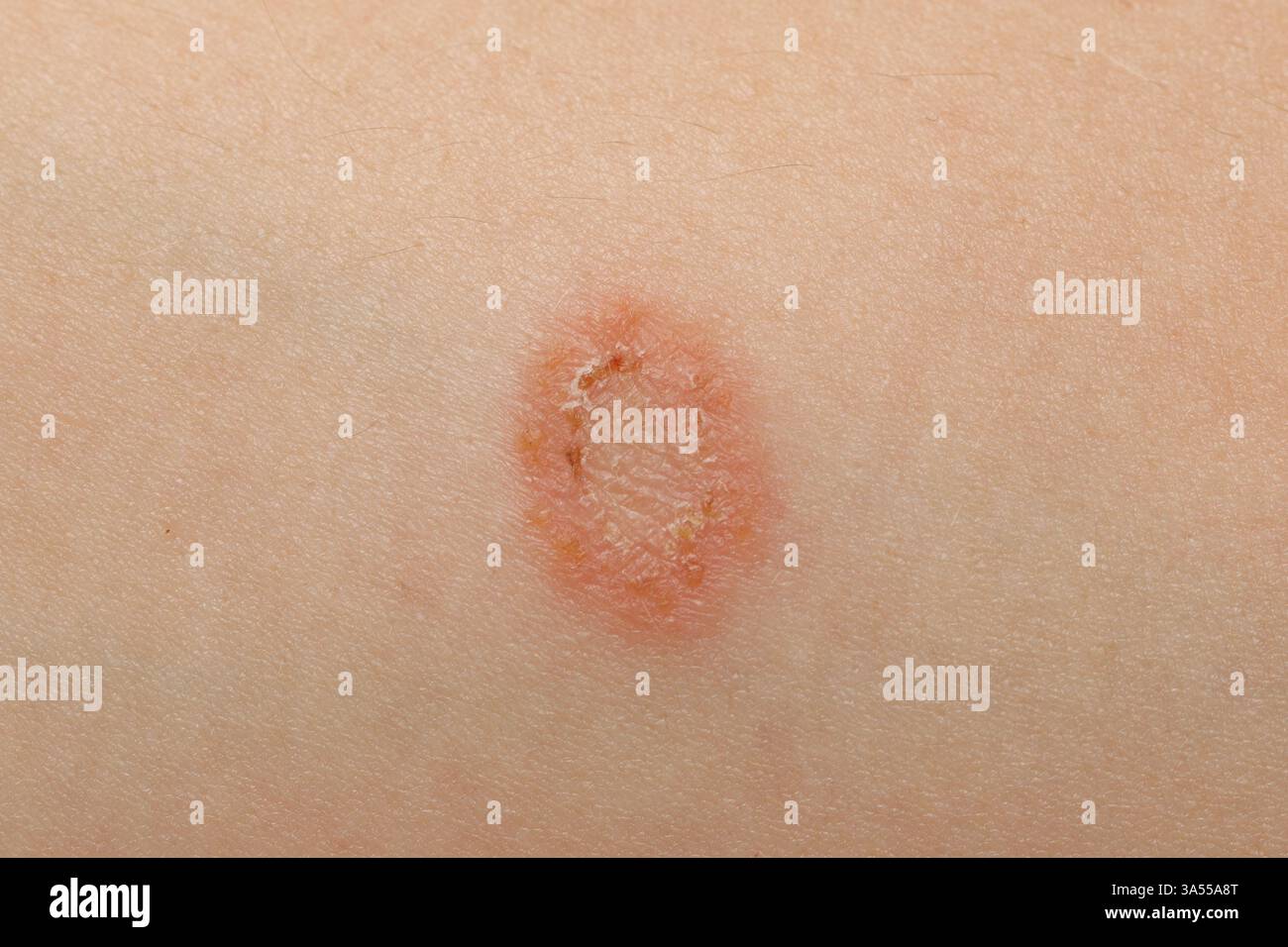 Dermatology disease on human skin. Infection rash, psoriasis, eczema or ...