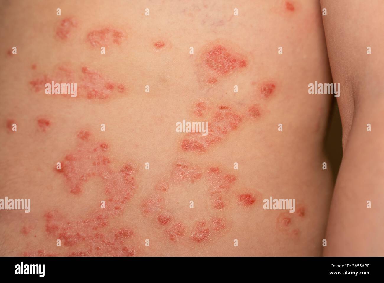 Psoriasis skin condition displaying red and scaly patches on the back ...