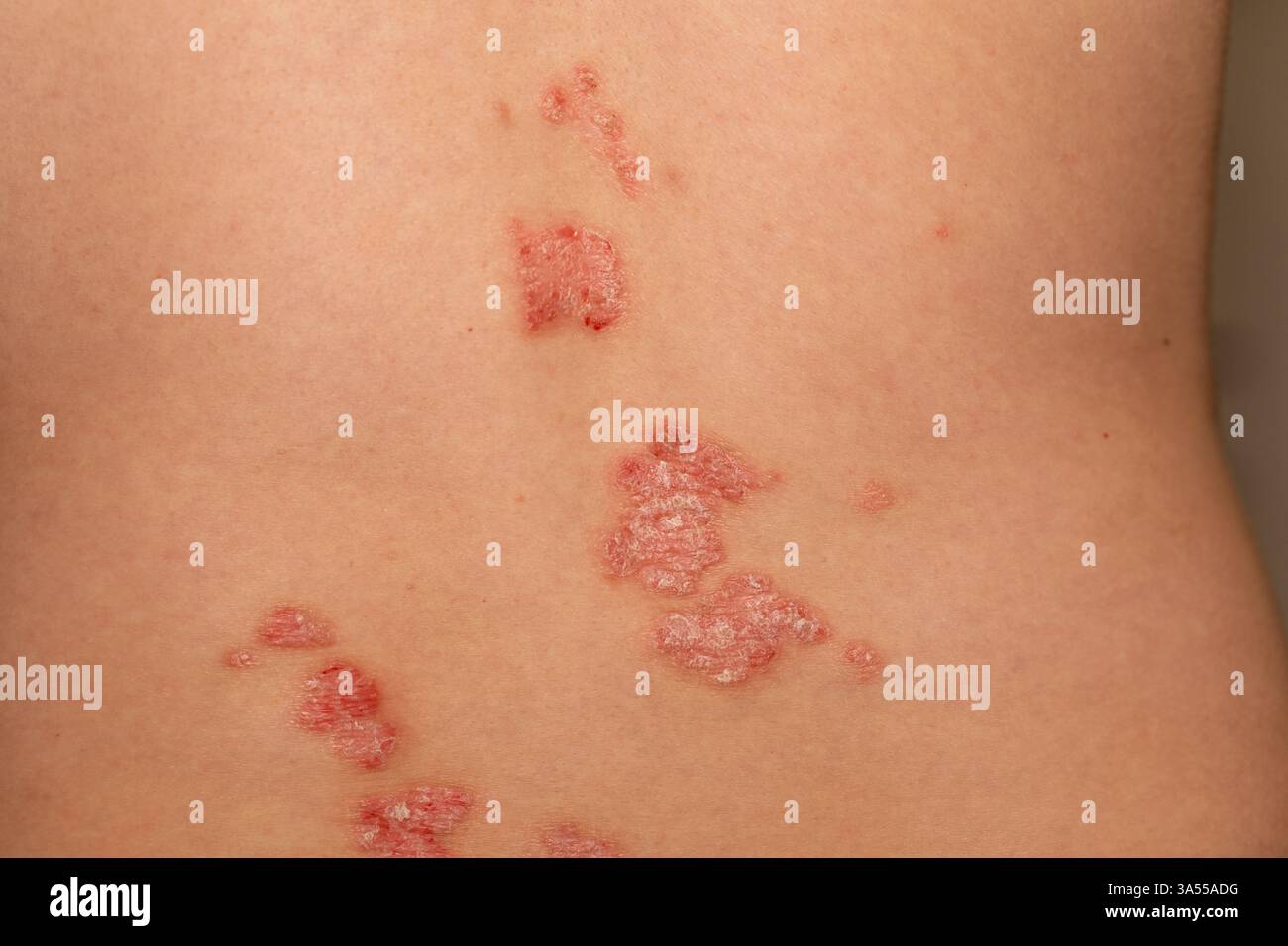 Psoriasis skin condition showing red, scaly patches on back during a ...