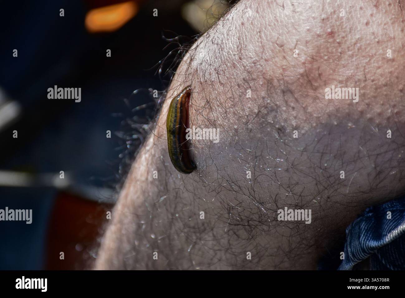 Srinagar, India. 21st Mar, 2025. A patient receives leech therapy on ...