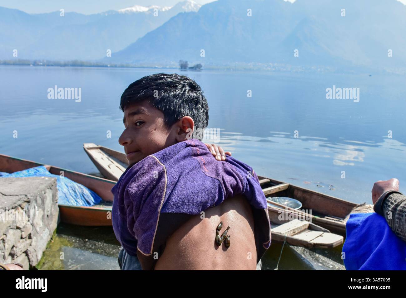 A patient receives leech therapy on his back on Nowruz, the day which ...