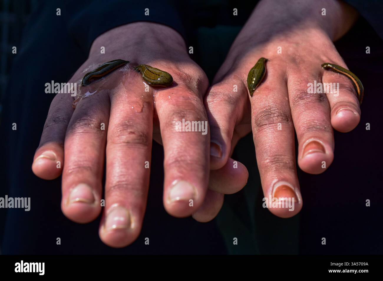 A patient receives leech therapy on her hands on Nowruz, the day which ...