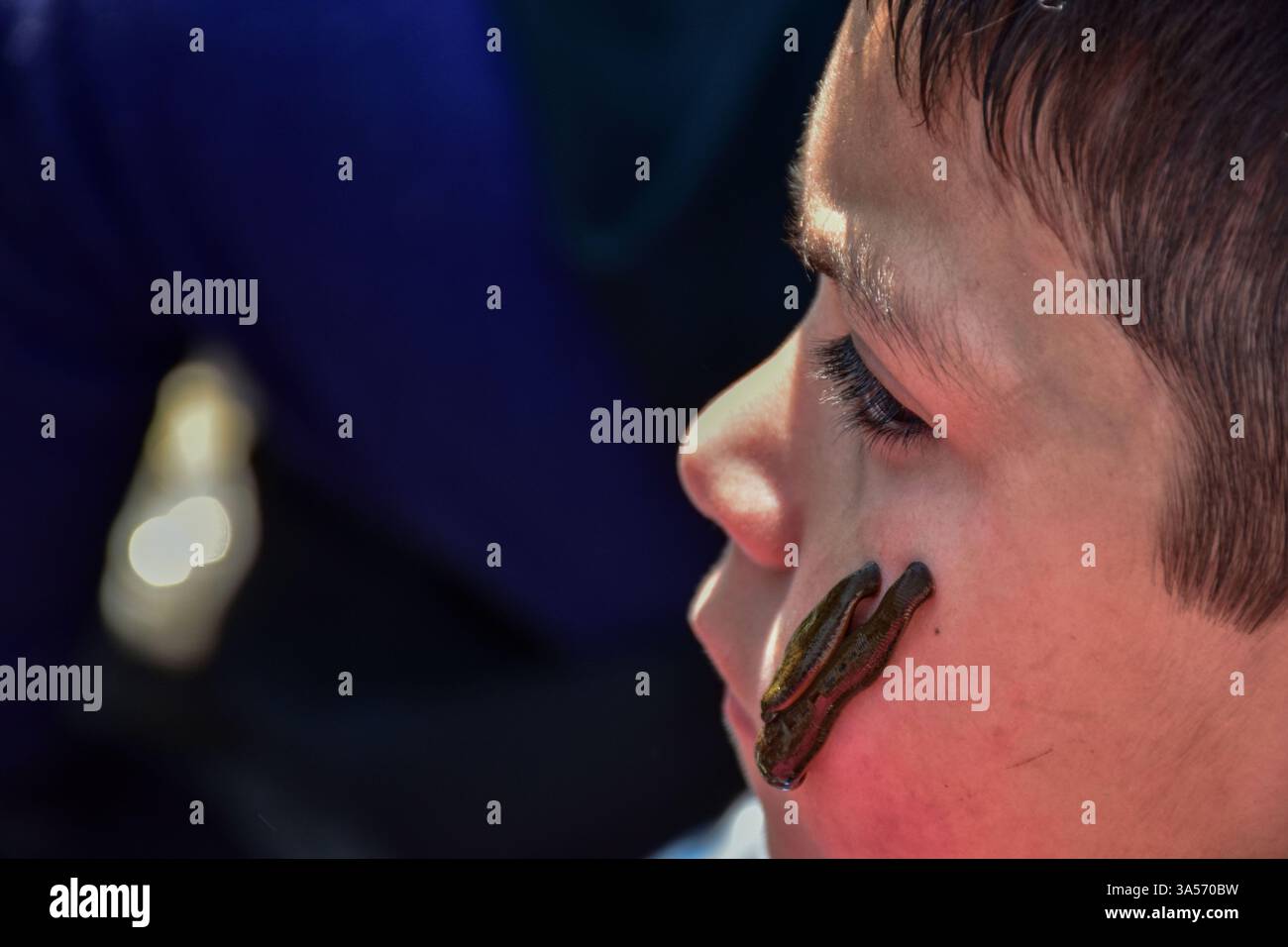 Srinagar, India. 21st Mar, 2025. A young boy receives leech therapy on ...