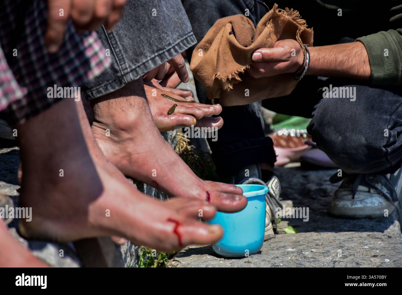 Kashmiri patients receive leech therapy on their feet from a ...