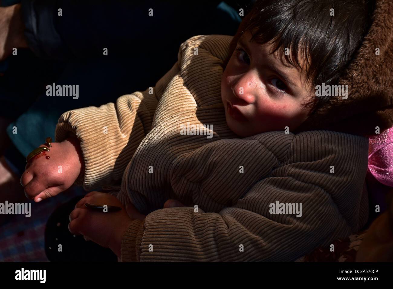 Srinagar, India. 21st Mar, 2025. A young patient receives leech therapy ...