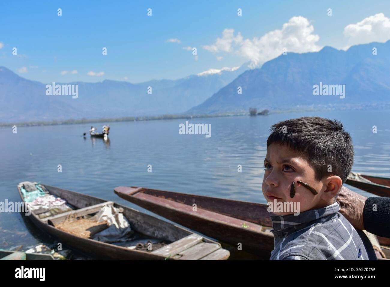 A young boy receives leech therapy on his face on Nowruz, the day which ...