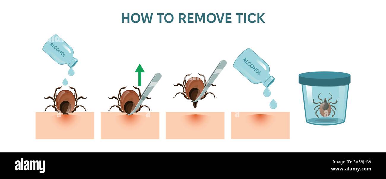 How to remove tick steps Infographic banner. Instruction to prevent Lyme or borreliosis disease ...