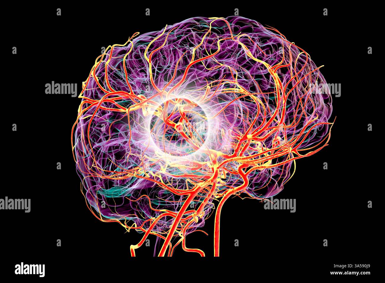 Illustration of a saccular (berry) aneurysm on the brain middle ...