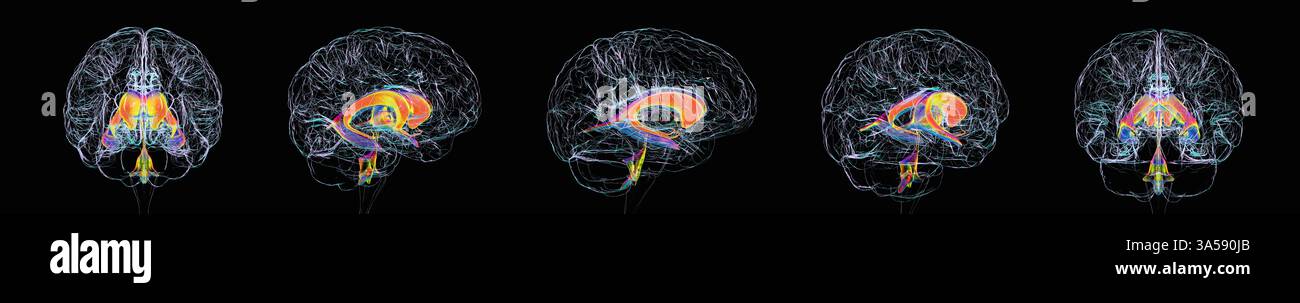 Illustration of the caudate nucleus (orange) and ventricles (rainbow ...