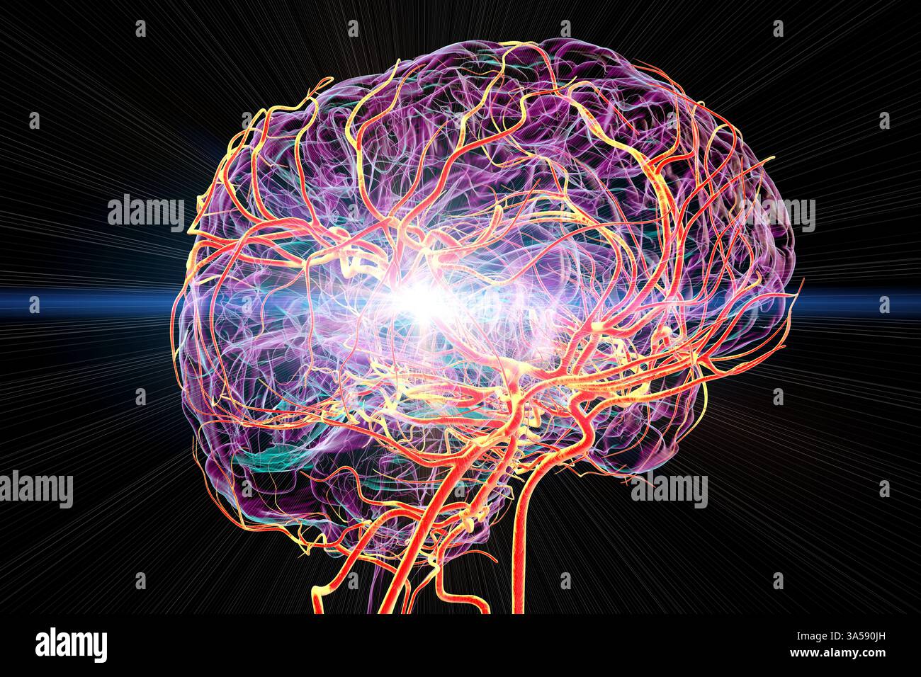Conceptual illustration of a brain with arteries, highlighting a stroke ...