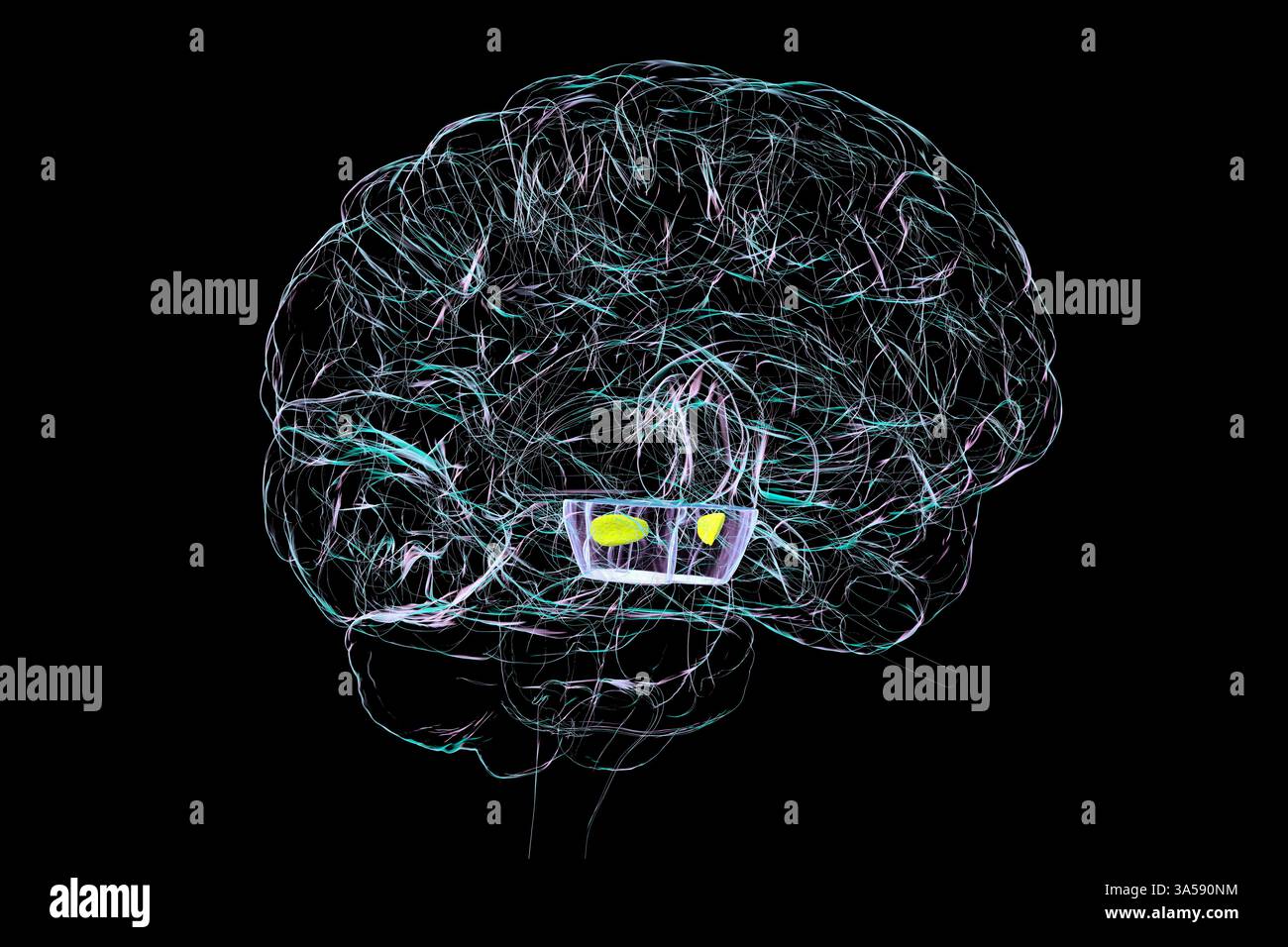 Illustration of the human brain with an atrophic substantia nigra ...