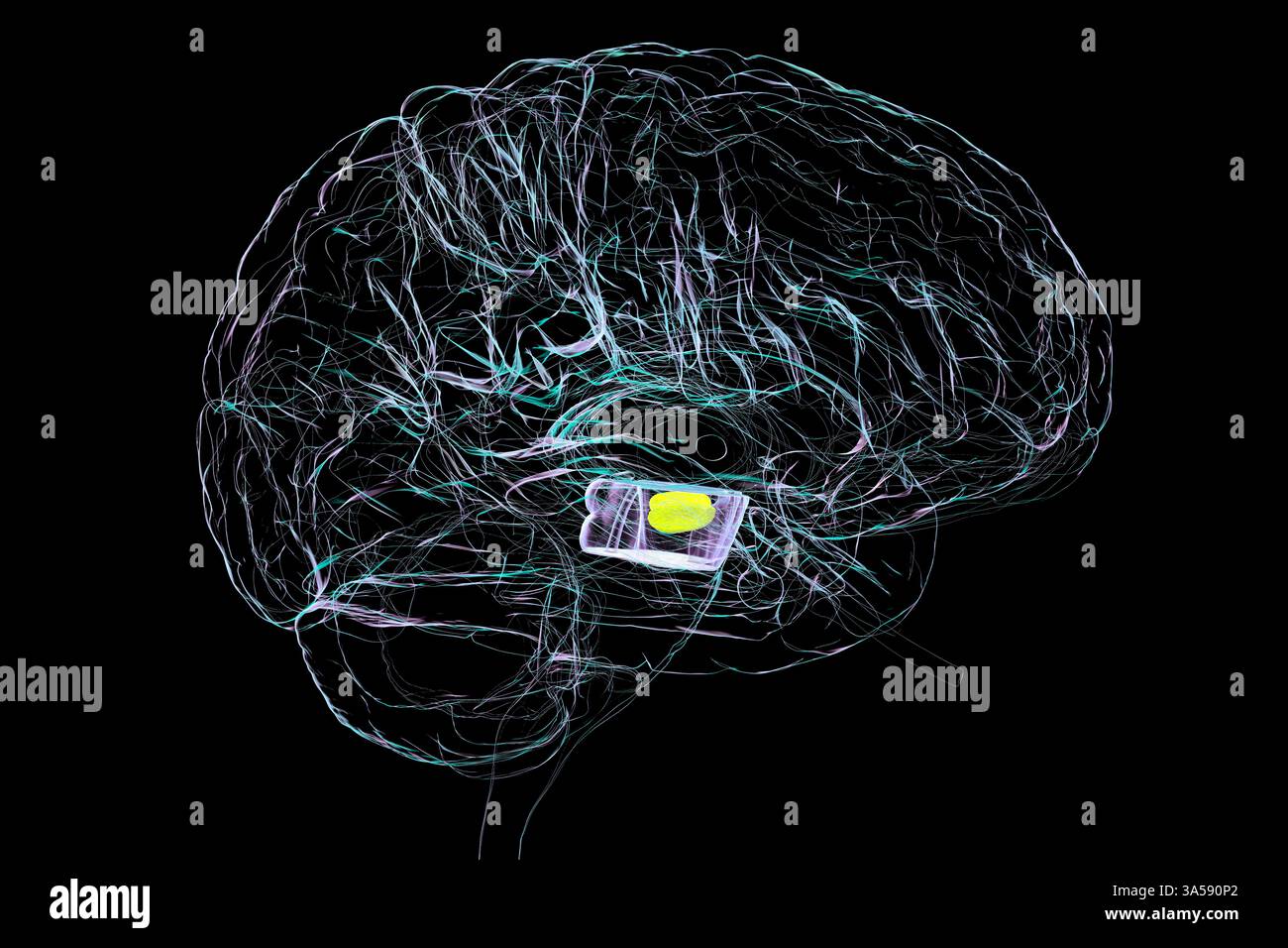 Illustration of the human brain with an atrophic substantia nigra ...