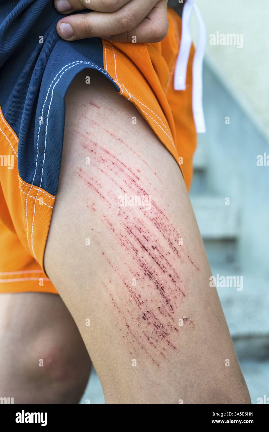 Blood bruise hi-res stock photography and images - Alamy