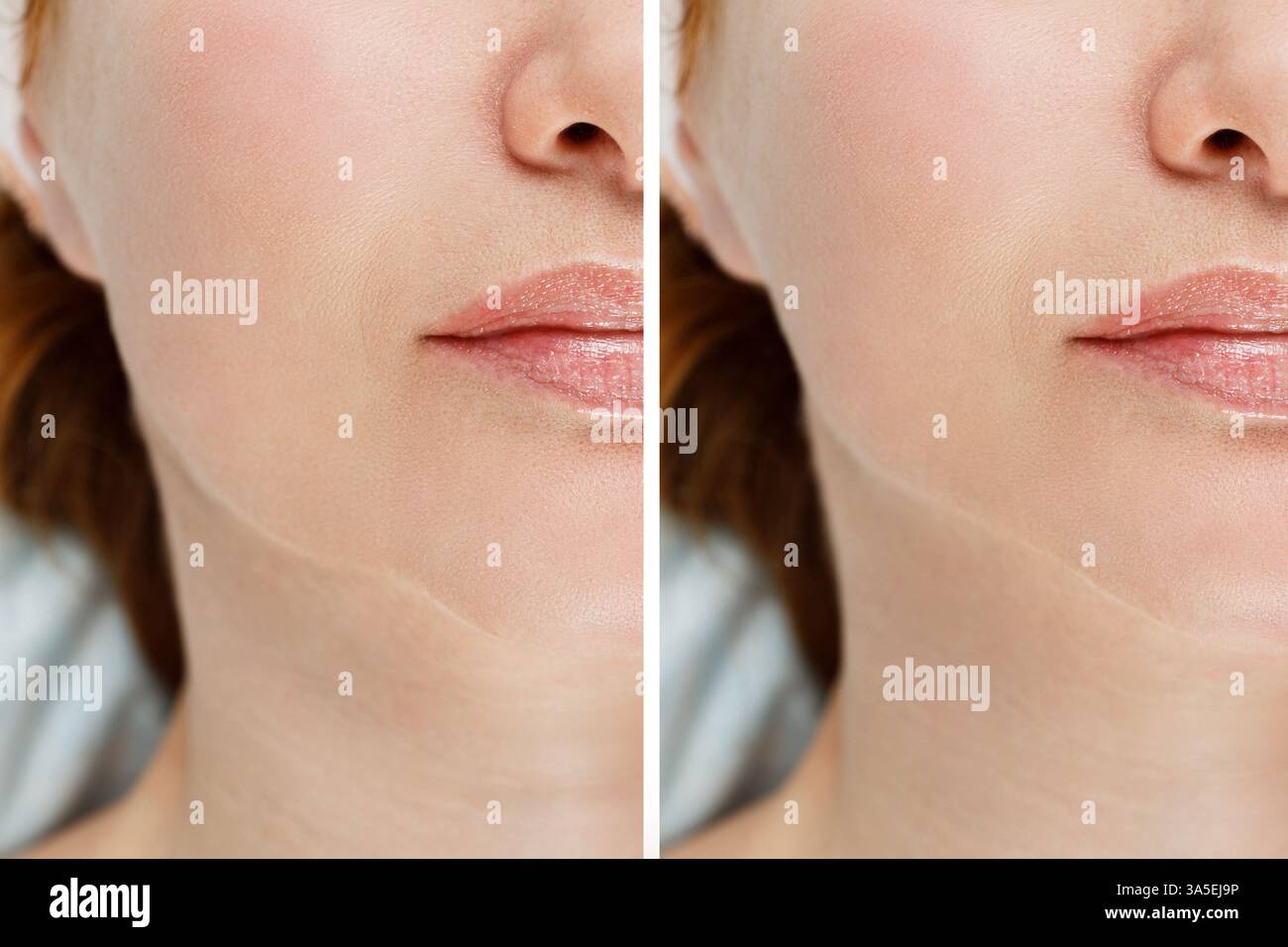 Female double chin before and after correction. Result of procedure in ...