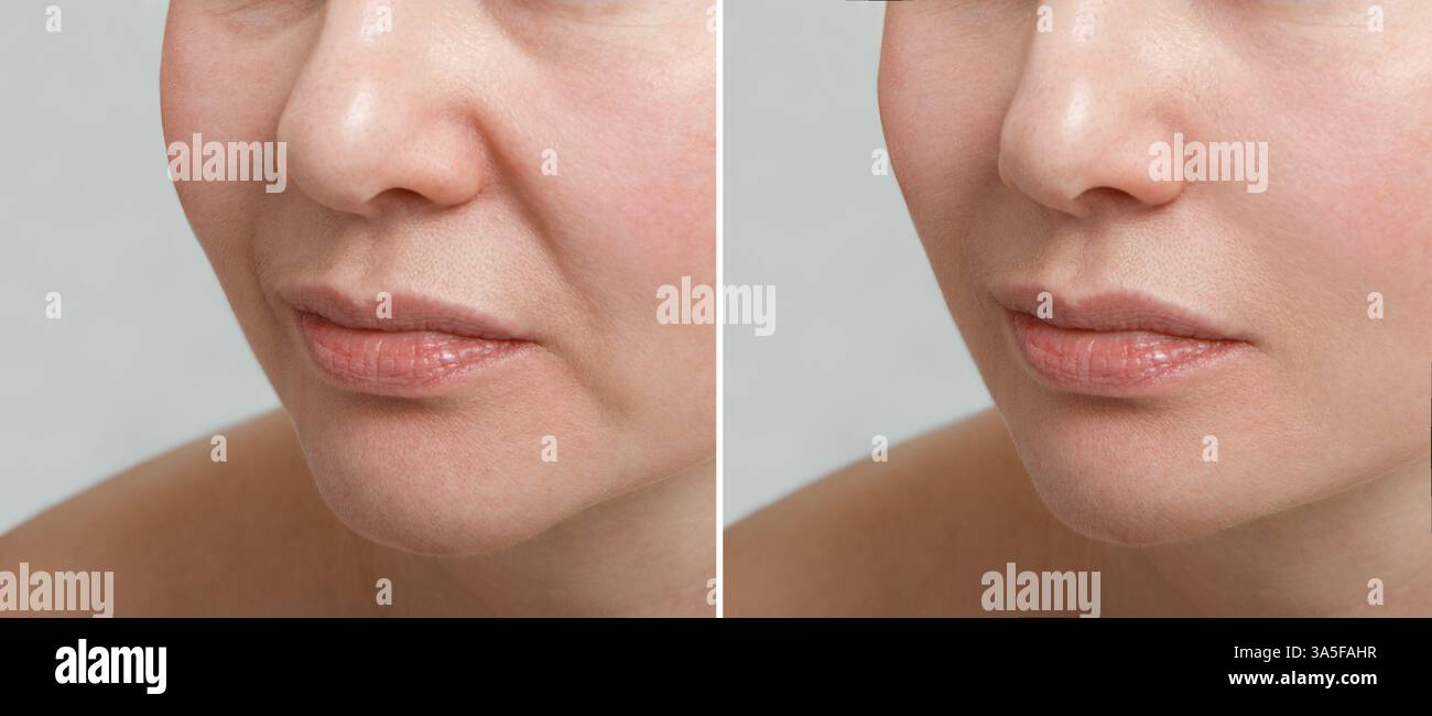 Female nasolabial fold before and after wrinkle smoothing procedures ...