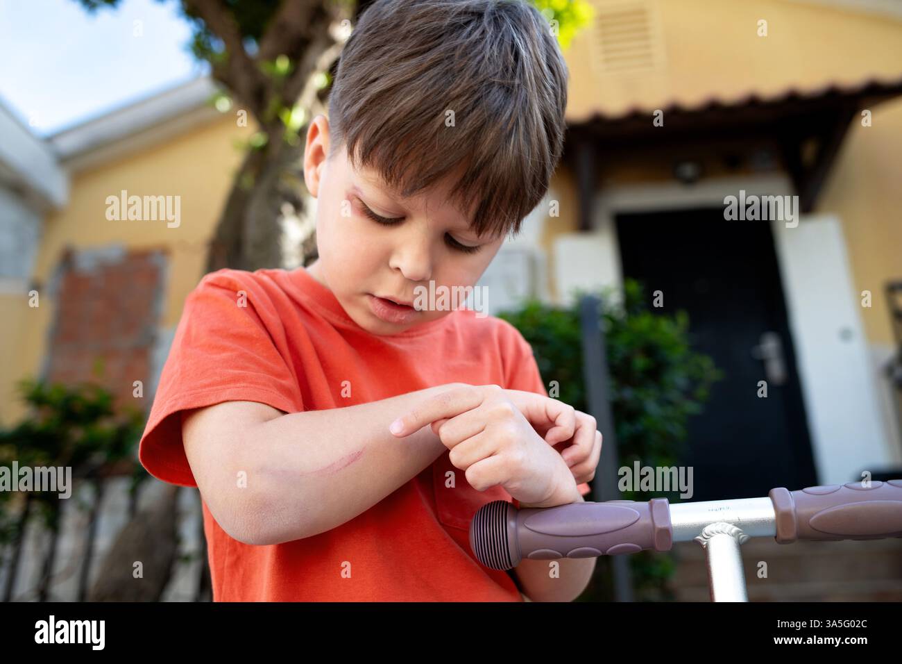 A boy with a bruise under his eye examines a scratch on his arm after ...