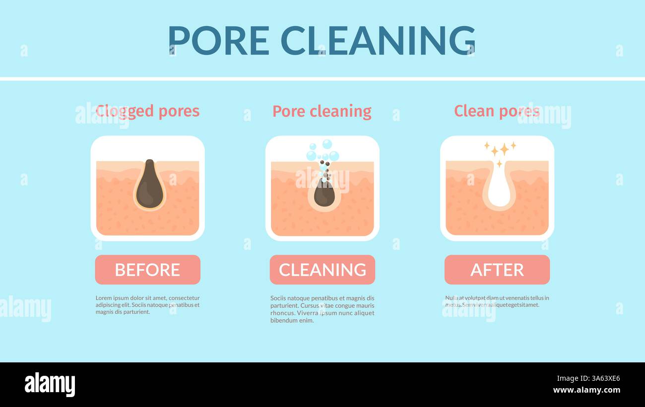 Skin pore cleaning, vector face care, blackhead acne treatment, beauty and dermatology medicine ...