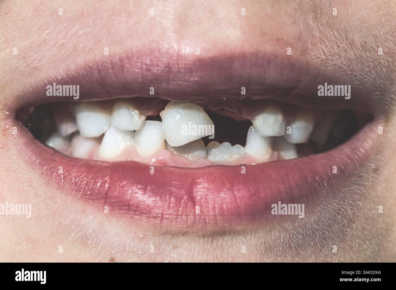 Child shows missing teeth. Child face Stock Photo - Alamy