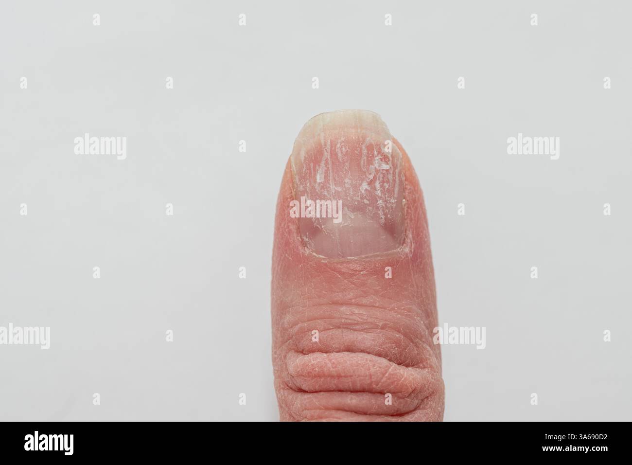 Close-up of a damaged fingernail with peeling and brittle surface on a ...