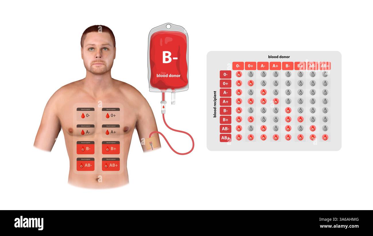 A medical illustration of a B Negative donor, showing transfusion ...