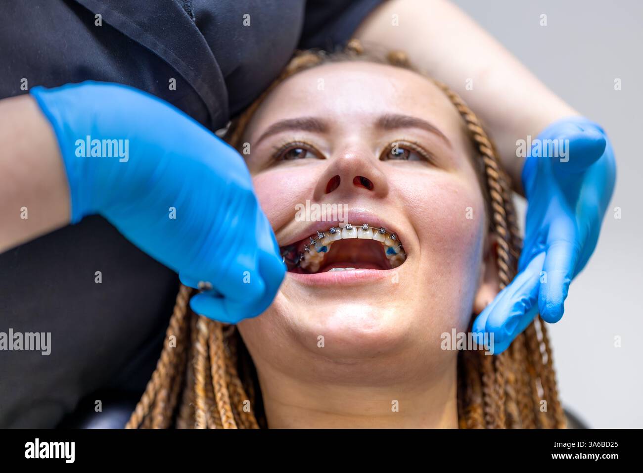 Dental procedure for installing braces close up. Dentistry. Braces on ...