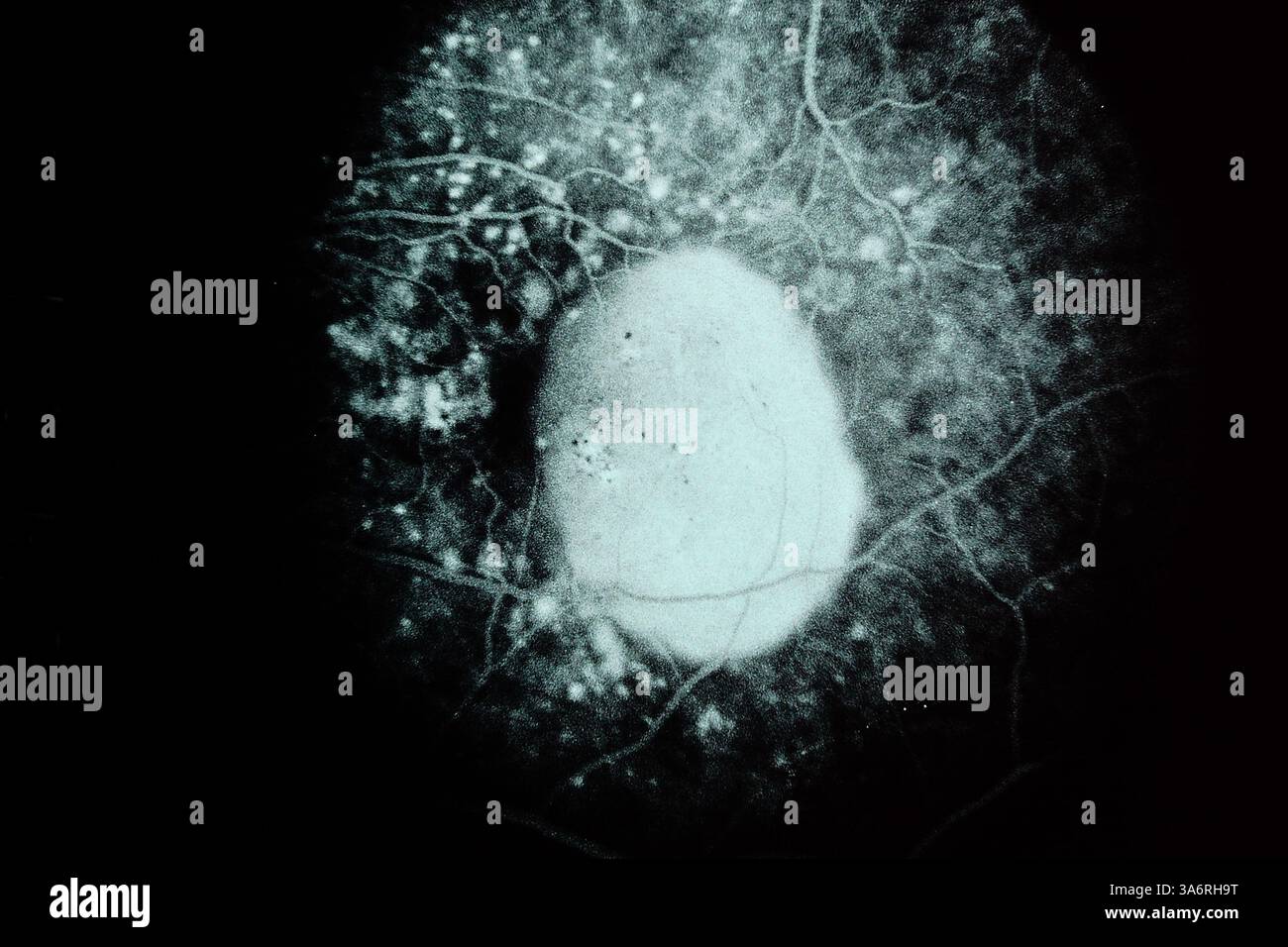 Fluorescein angiogram showing a retinal pigment epithelial detachment ...