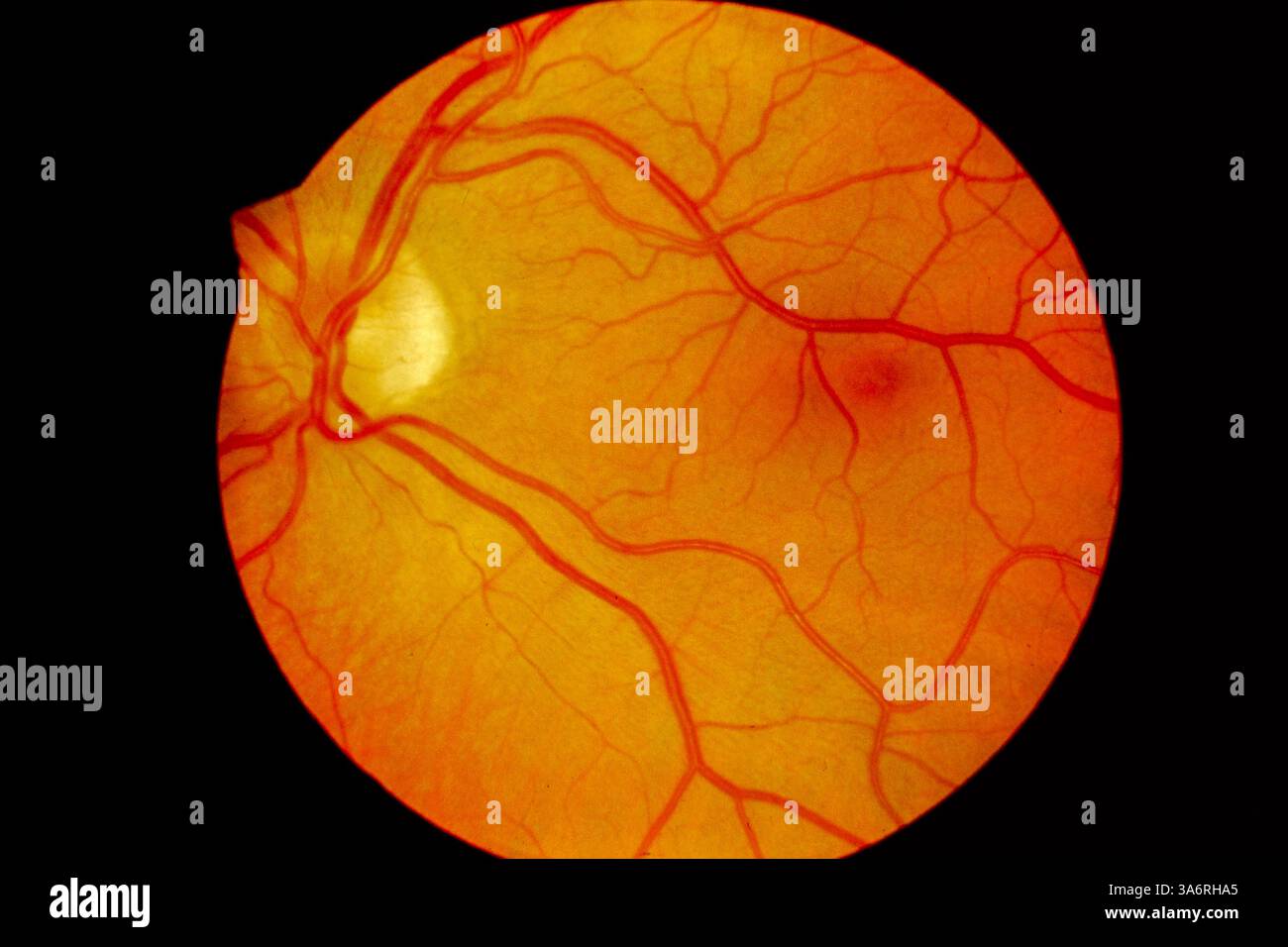 Fundoscopy scan of an arteriovenous anastomosis in the left eye ...