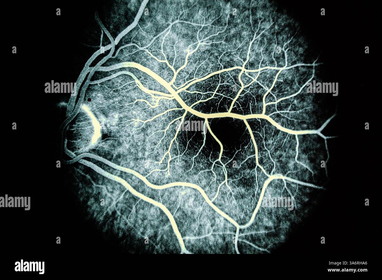Fluorescein angiogram of an arteriovenous anastomosis in the left eye ...