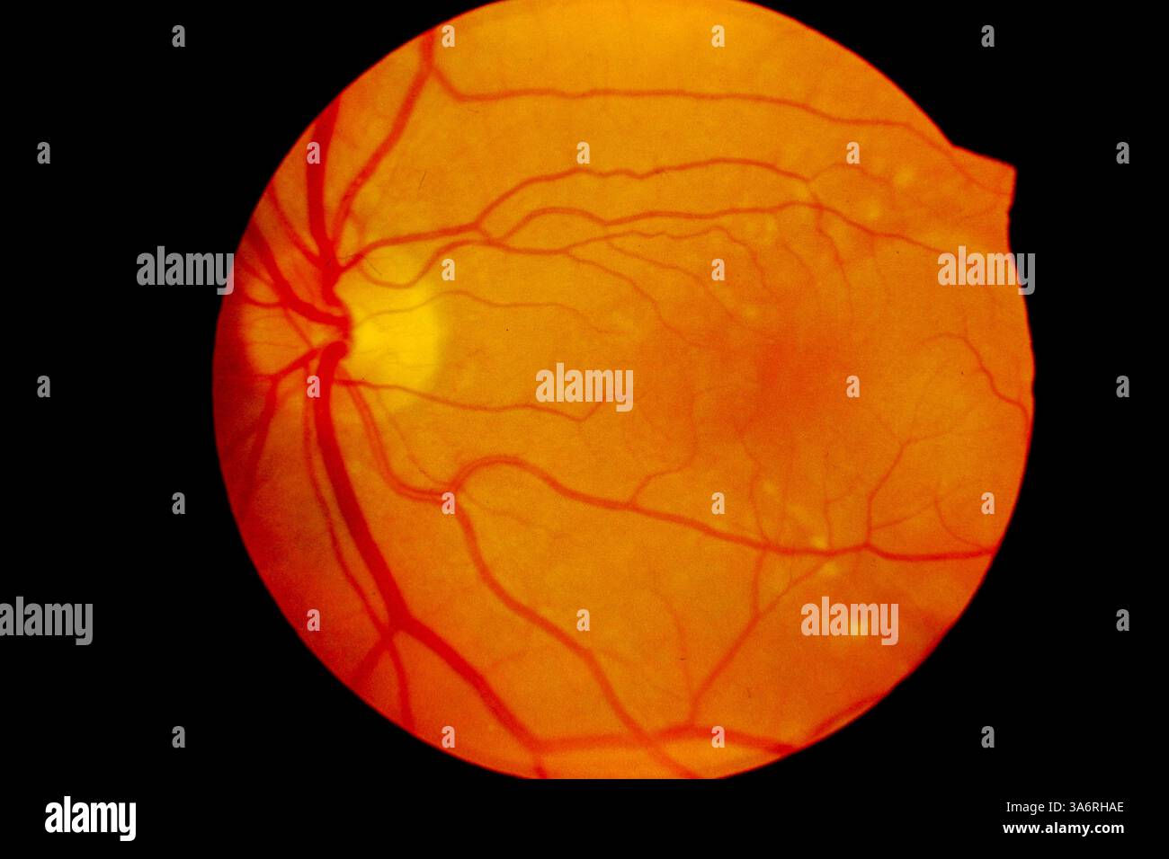Fundoscopy scan showing retinal pigment epithelial detachment in the ...