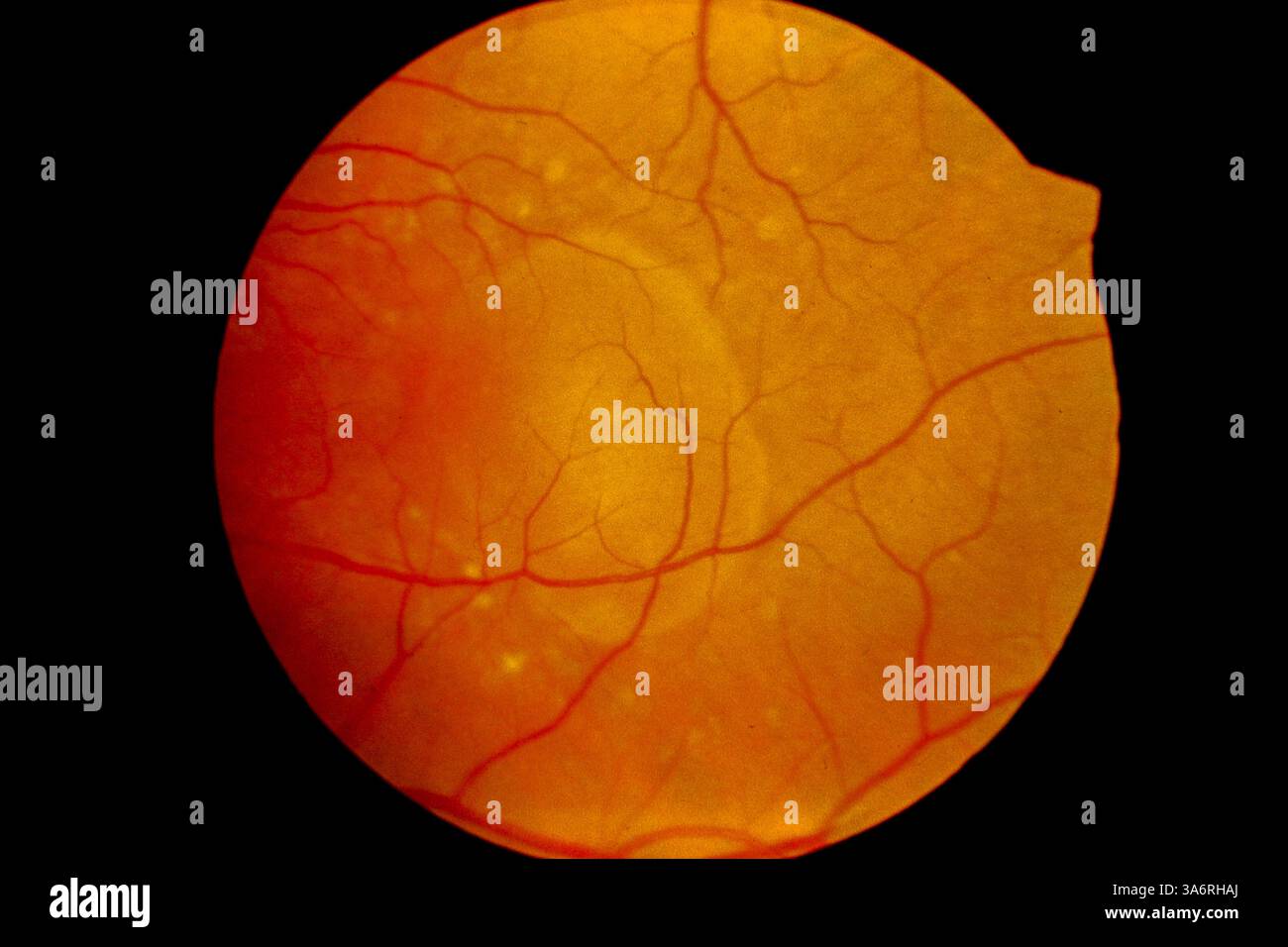 Fundoscopy scan showing retinal pigment epithelial detachment in the ...