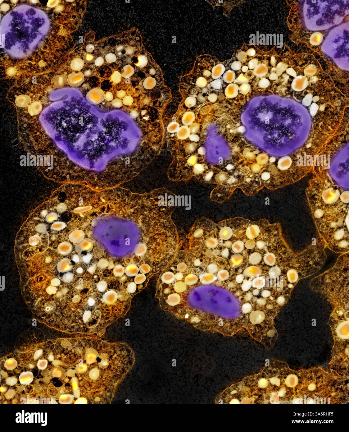 Eosinophils in hypereosinophilic syndrome. Coloured transmission electron micrograph (TEM ...