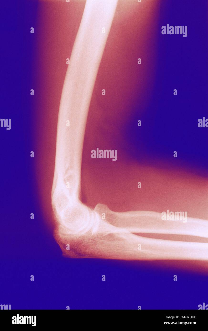 Bent elbow. Coloured X-ray of the bones (red) of a bent elbow joint ...