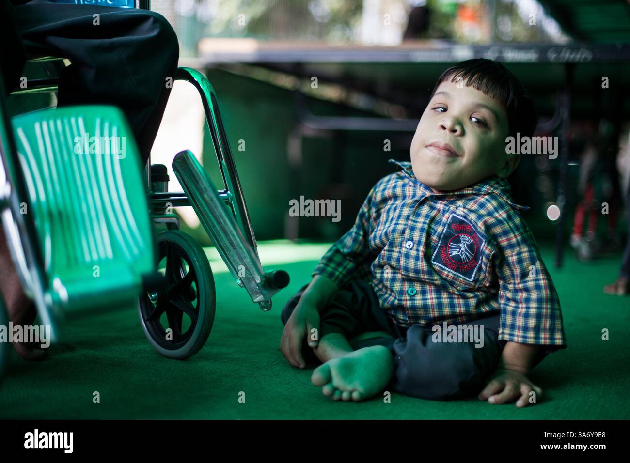 Deformities india children hi-res stock photography and images - Alamy