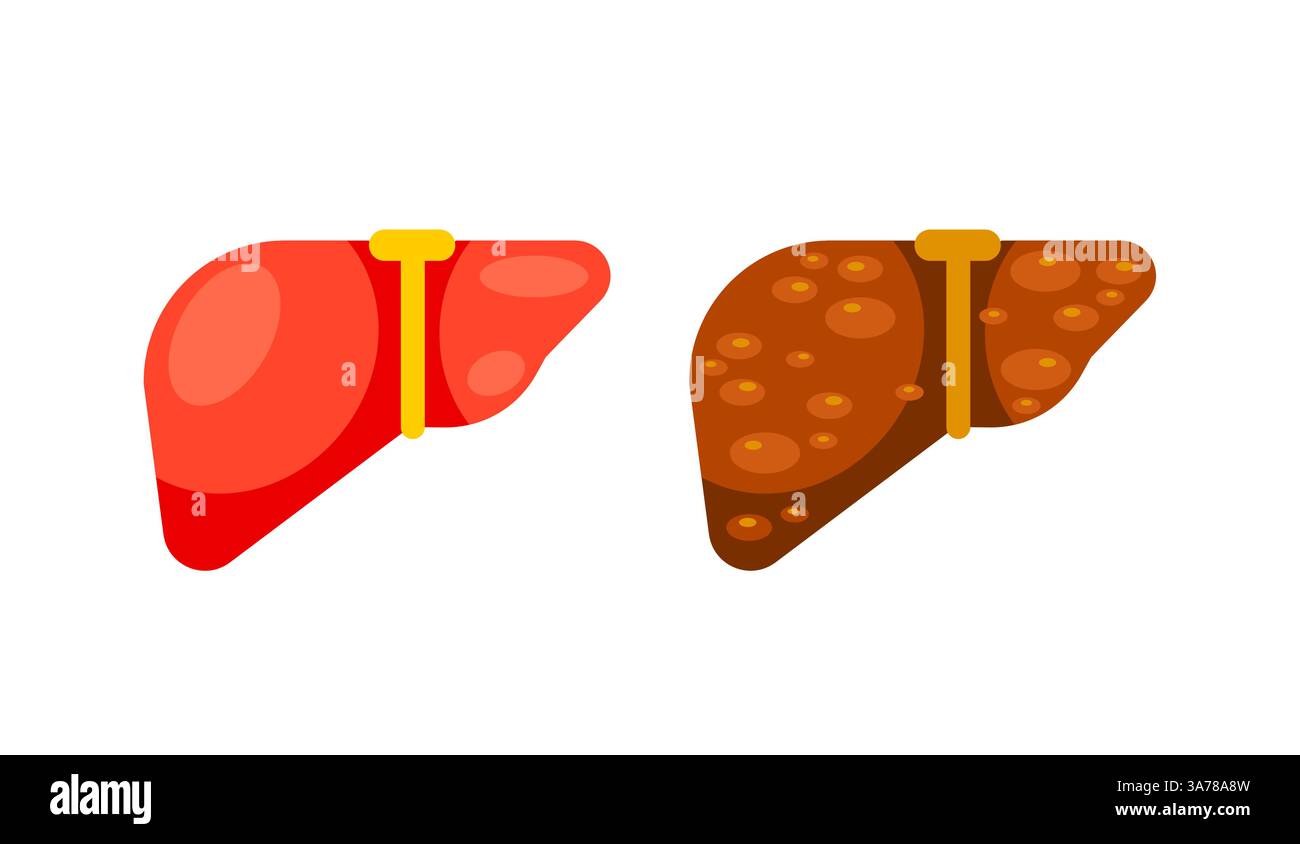Healthy liver and liver cirrhosis disease. Human liver organ. Vector ...