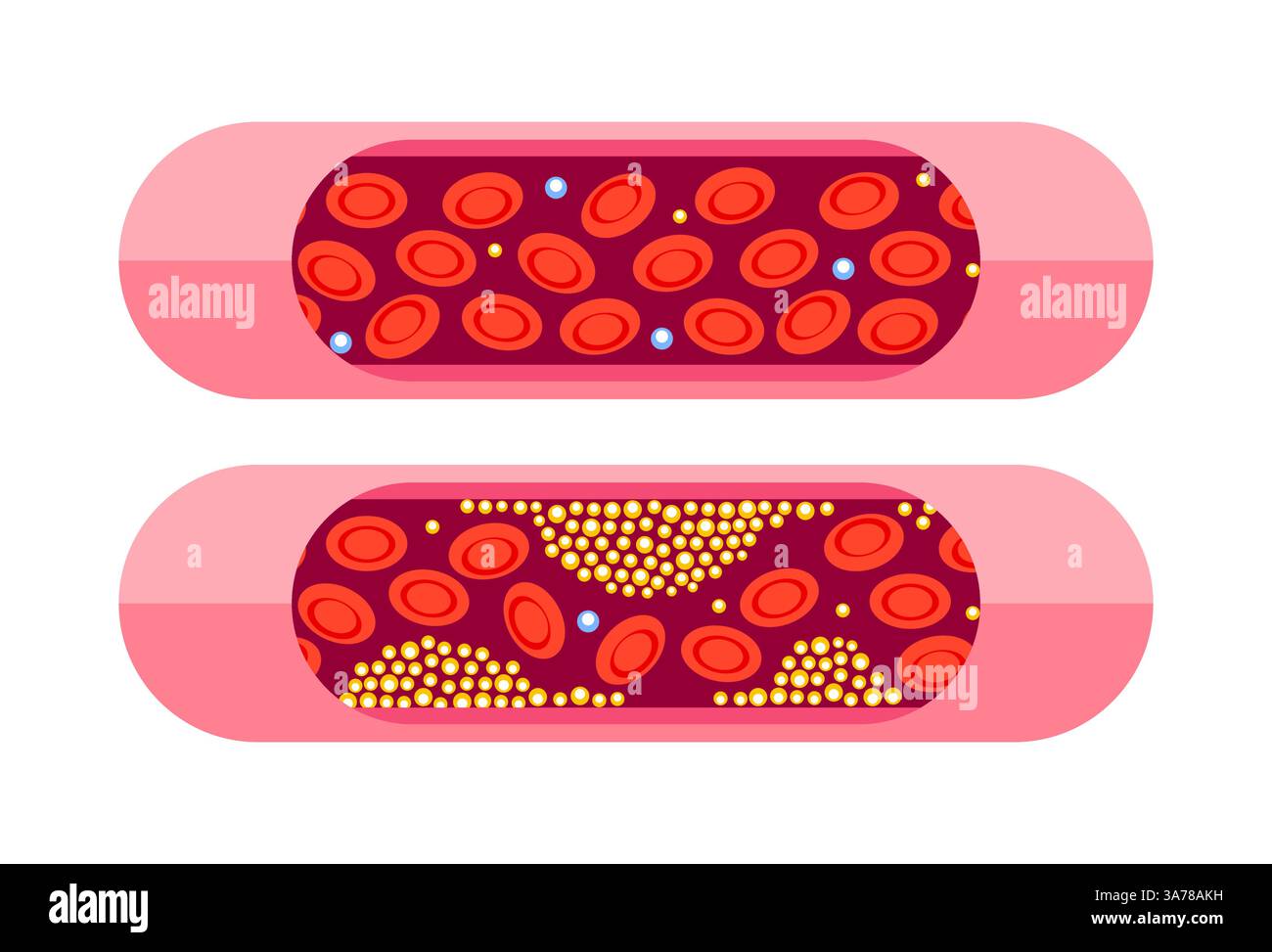 Types of cholesterol. HDL and LDL cholesterol types. Labeled ...