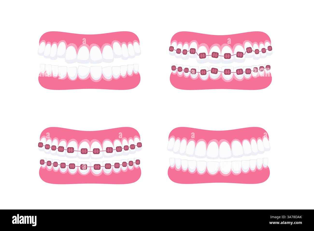 Teeth with braces. Orthodontic treatment. Tooth braces. Teeth with metal brackets Stock Vector ...