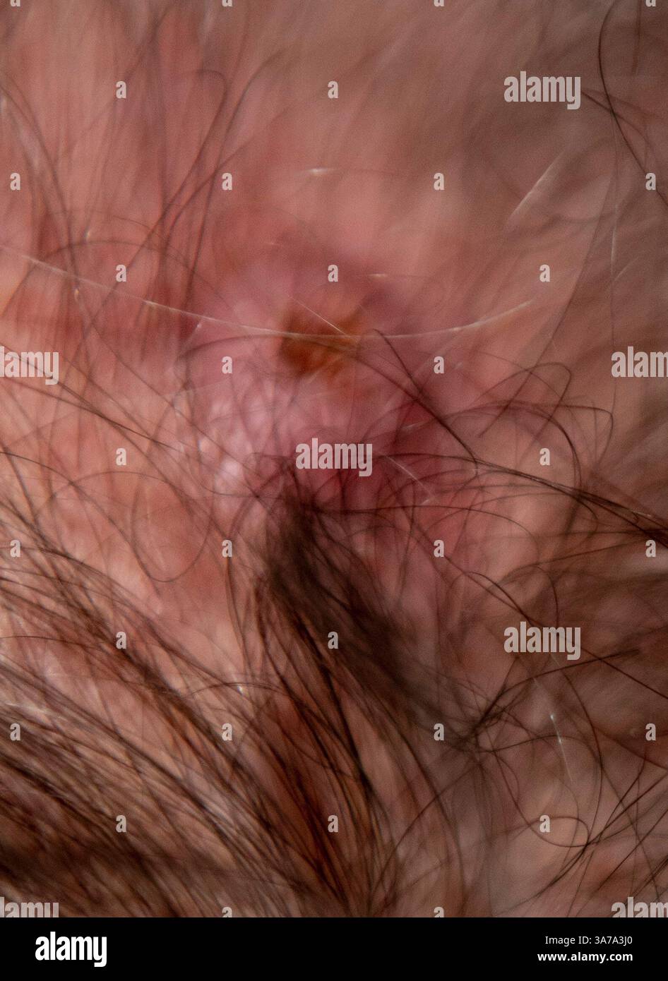 Squamous cell carcinoma (SCC) of the skin is the second most common ...